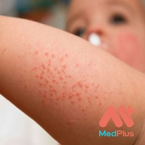 4 ĐIỀU CẦN BIẾT VỀ BỆNH RUBELLA LÀ GÌ?